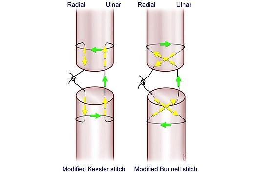 最佳缝合结果 - 爱爱医医学网